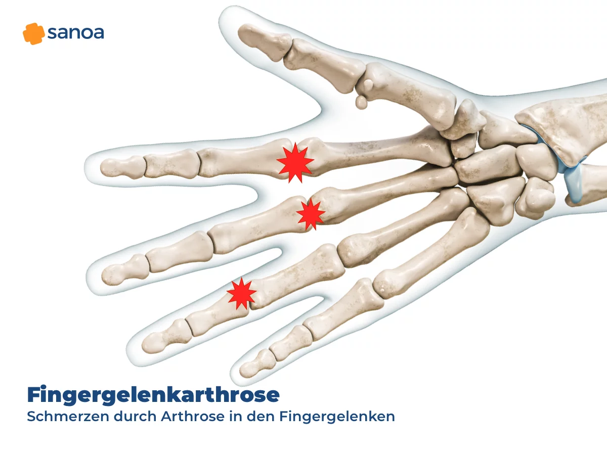 Heberden Arthrose Finger Fingergelenkarthrose Ursachen, Symptome,